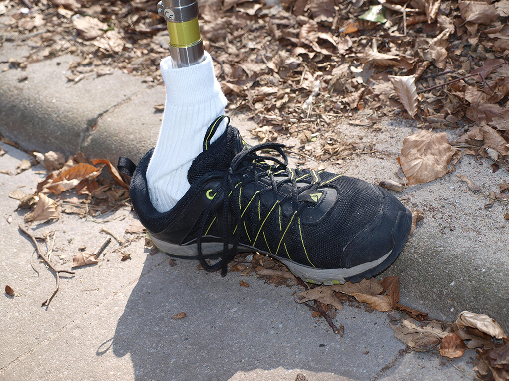 Fühlende Beinprothese - MedMix