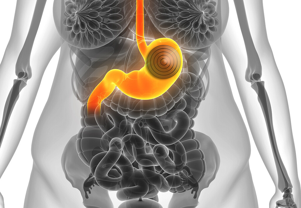 Operation bei Adipositas – neue endoskopisch platzierte Magenballons