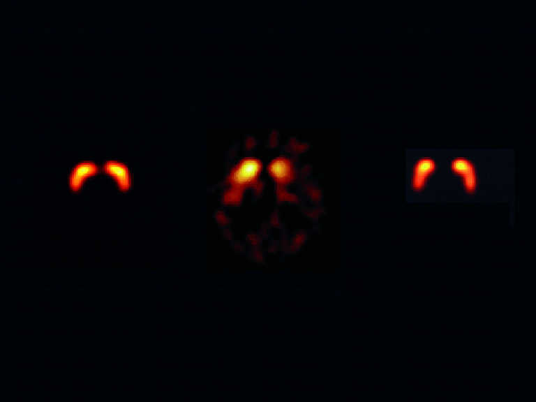 Dopamin-Transporter-Szintigraphie (DaT-SPECT) bei Parkinson
