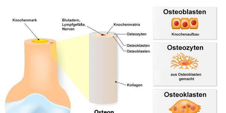 Normale und osteoporotische Knochen - MedMix