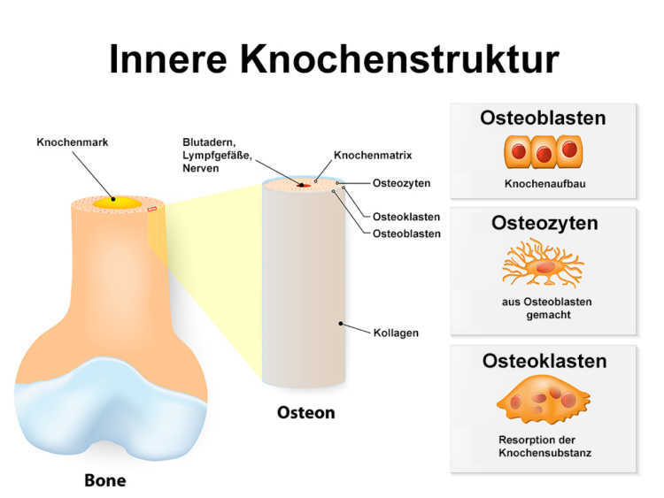 Normale und osteoporotische Knochen - MedMix