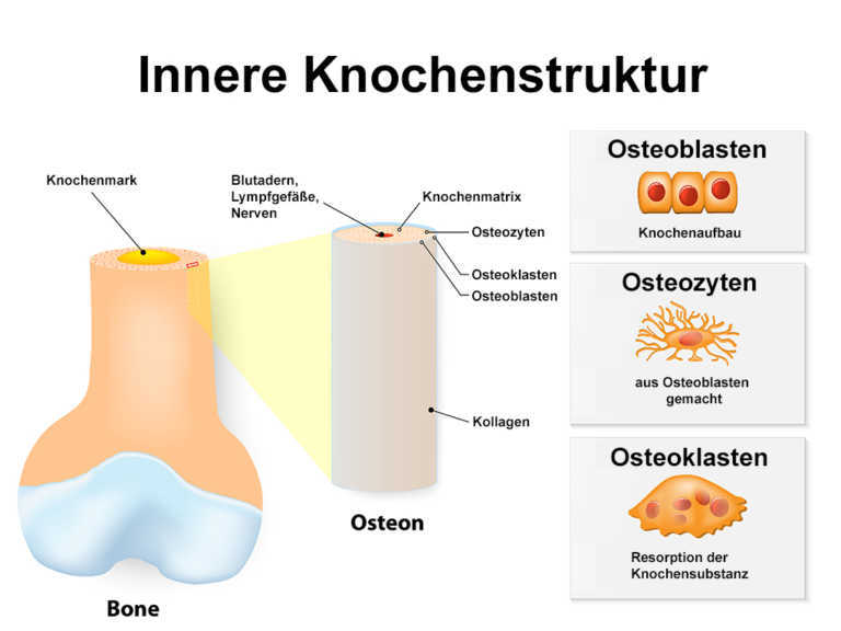 Normale und osteoporotische Knochen - MedMix