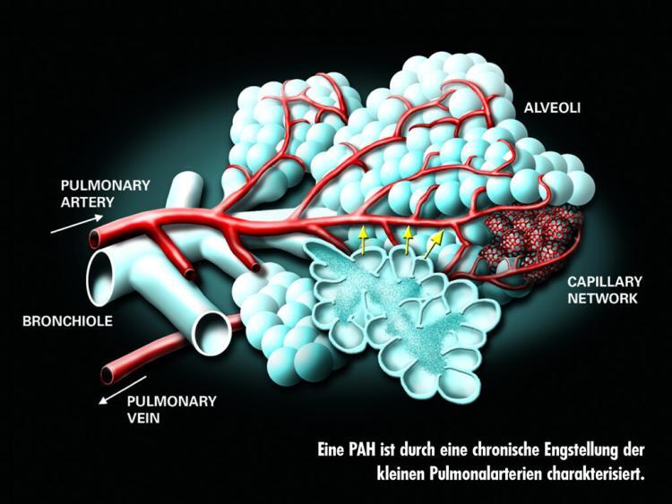 Pulmonale Hypertonie – Klassifikation und Pathophysiologie
