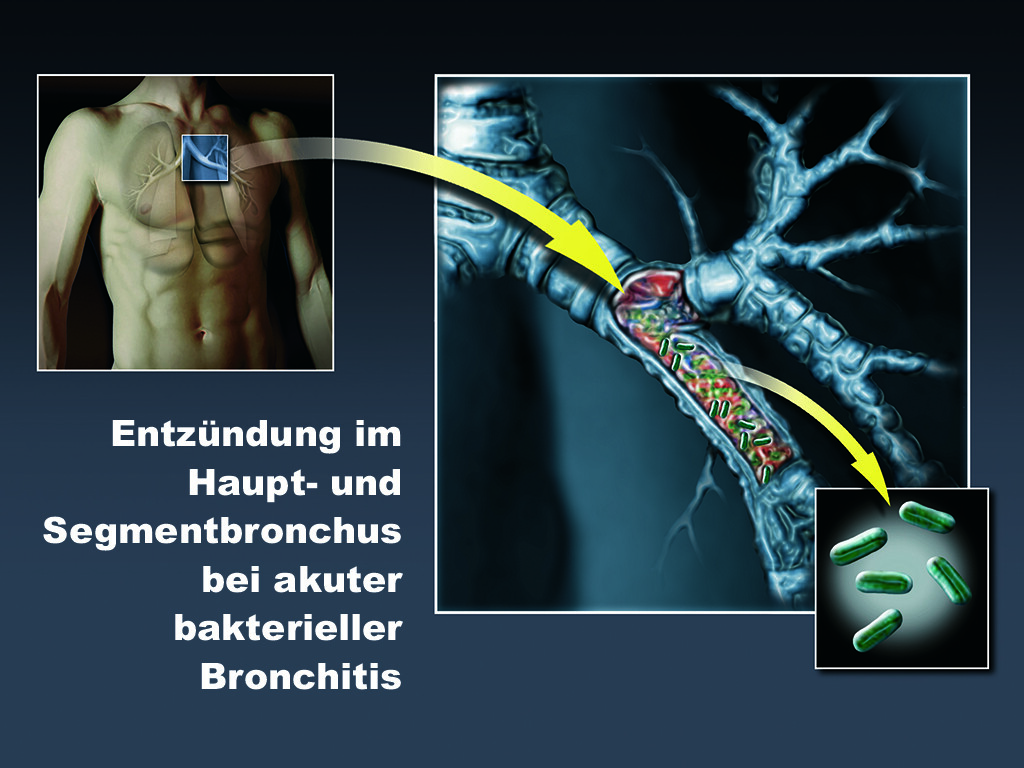 akute bronchitis - MedMix