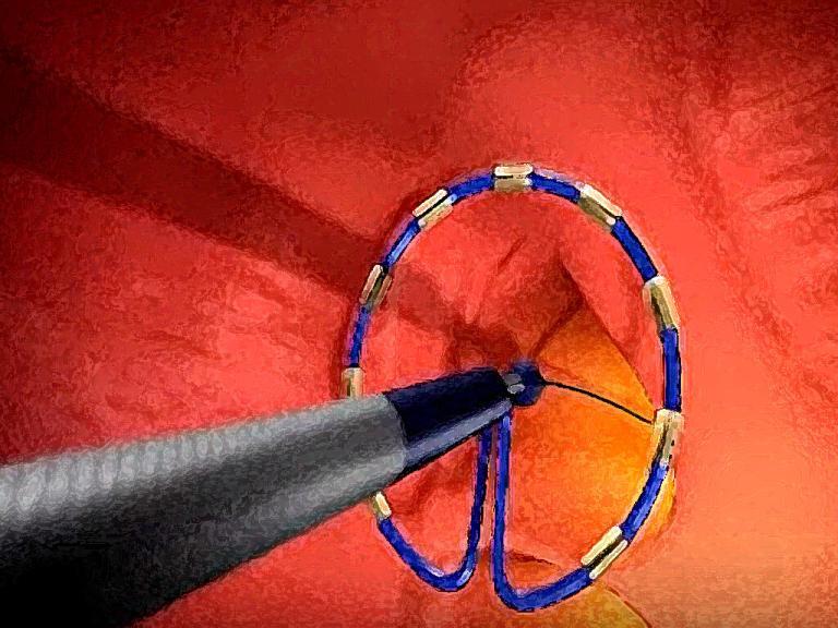 Katheterablation von Vorhofflimmern – die Gap-AF-Studie - MedMix