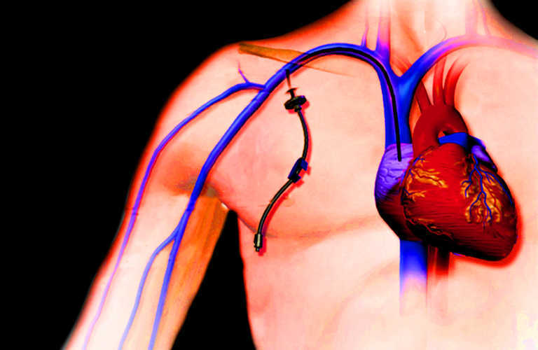 Zentrale Venenkatheter durch Ultraschall sicherer - MedMix