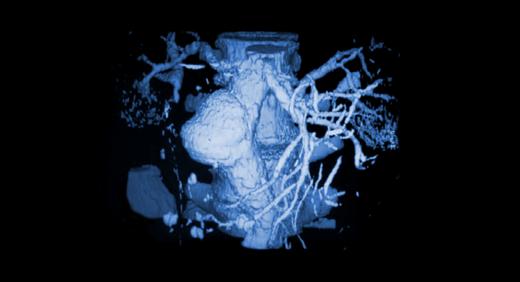 Screening der Bauchschlagader mittels Ultraschalluntersuchung