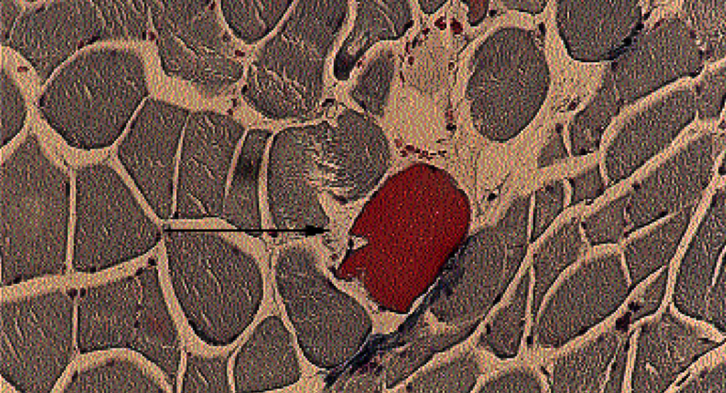 Muskelverhärtungen: Myogelosen aus anatomischer Sicht