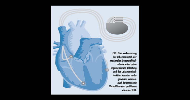 CRT – Kardiale Resynchronisationstherapie - MedMix