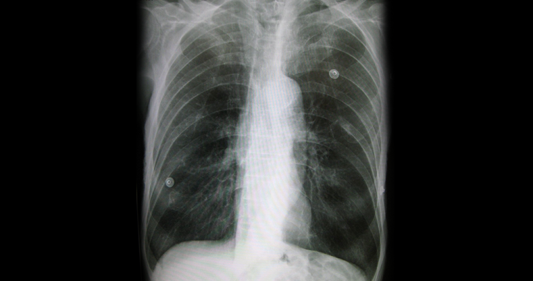 Atemlosigkeit, Atemnot, bei Lungenemphysem: Ursachen und Symptome