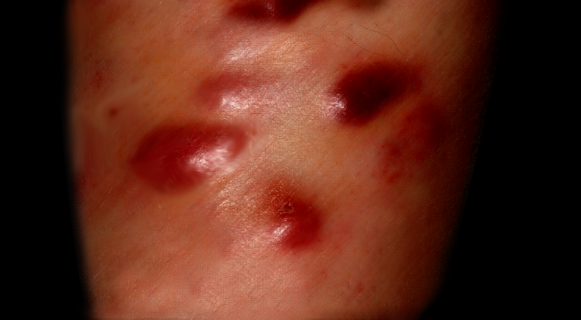 Kutane Lymphome: Symptome und Therapien von Hautkrebs-Arten