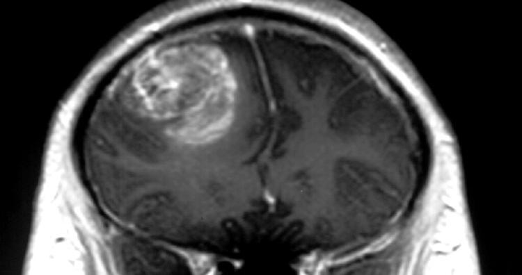 Strahlentherapie und Chemotherapie beim Hirntumor Glioblastom