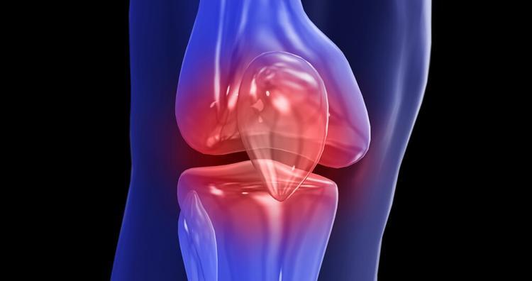 Gonarthrose – Kniegelenkarthrose: Effektive Optionen zur Behandlung