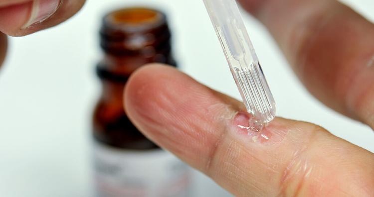 Warzen behandeln, Warzen vereisen, Warzen entfernen