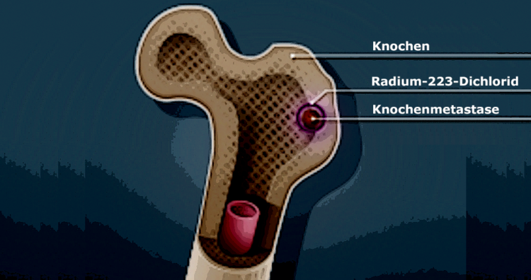 Alpha-Strahler Radium-223-Dichlorid - MedMix
