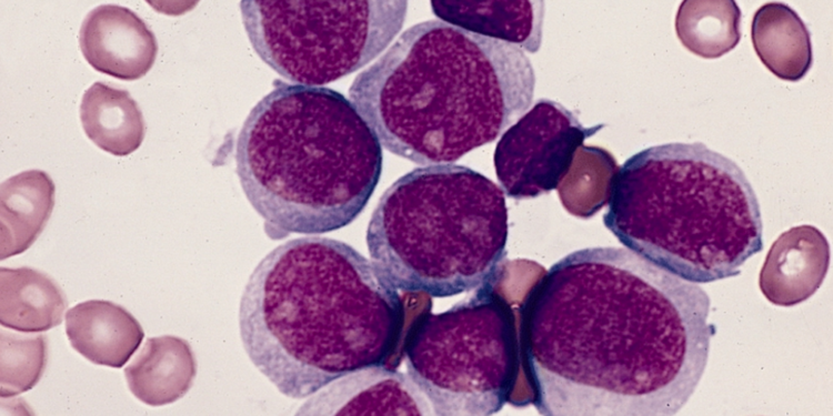 Akute myeloische Leukämie: die Therapie ist belastend und langwierig