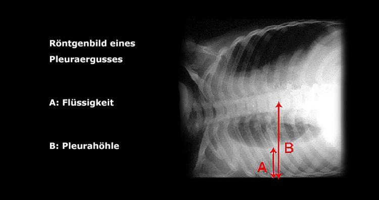 Transudat, Exsudat, Pleuraerguss: Flüssigkeit in der Brusthöhle
