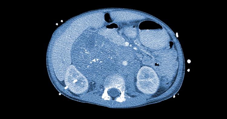 Neue Therapie bei Neuroblastom - MedMix