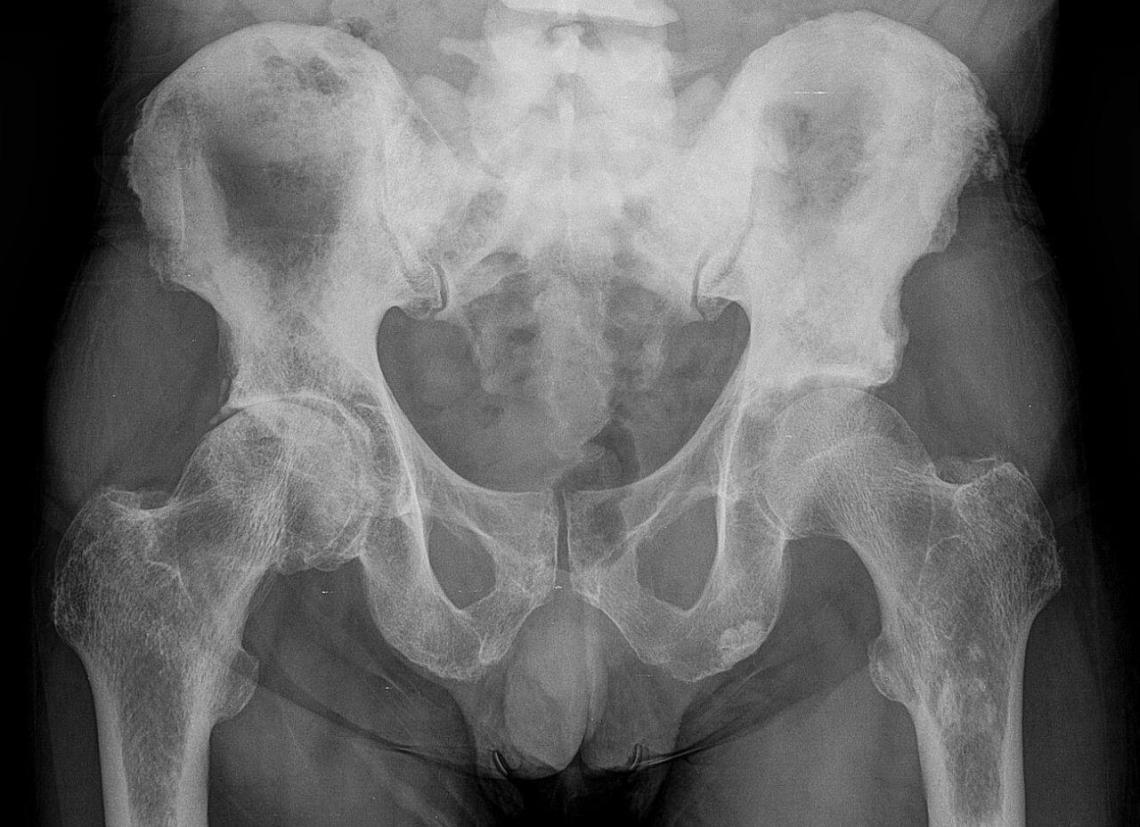 Knochenmetastasen: Krebszellen vom primären Tumor im Knochen