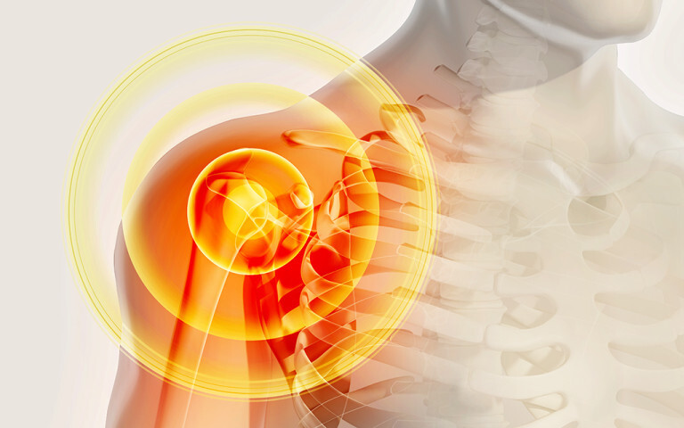 Omarthrose, Osteoarthritis, Frozen Shoulder der Schulter (Schultergelenk)