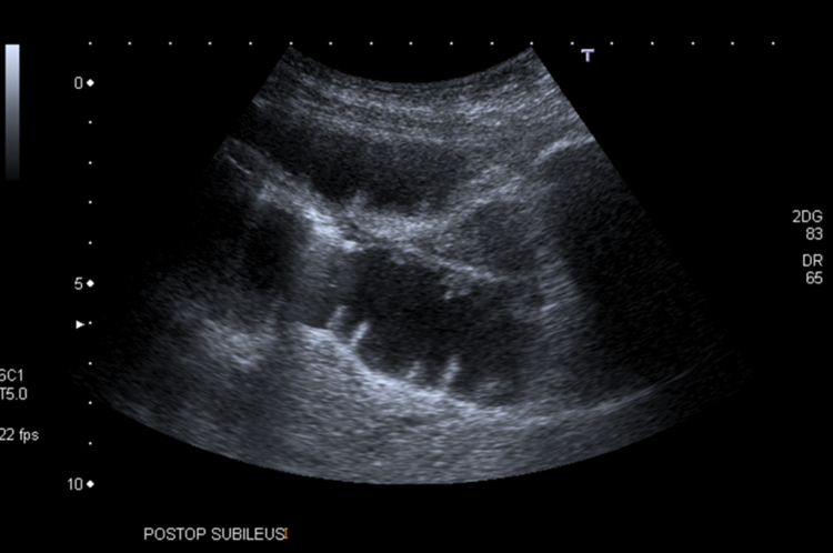 Ultraschall des magen-Darm-Trakts - MedMix