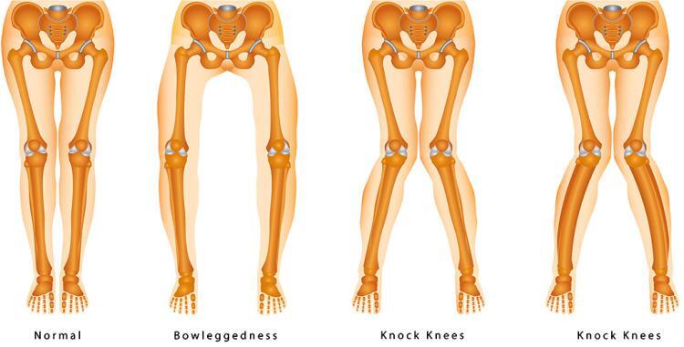 Verschleiß Kniegelenk-Knorpel: Arthrose durch X-Beine und O-Beine