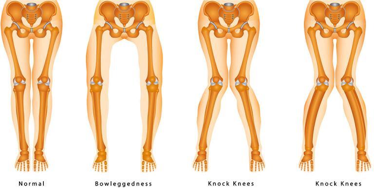 Verschleiß Kniegelenk-Knorpel: Arthrose durch X-Beine und O-Beine