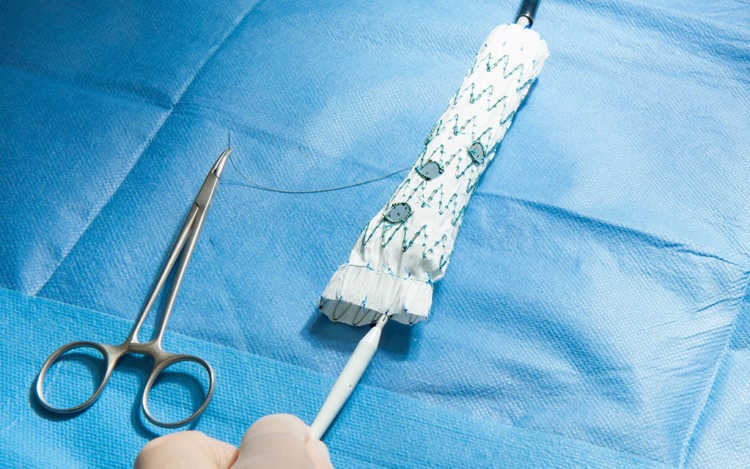 Stentprothese, individuell angefertigt, rettet bei Aortenruptur Leben.