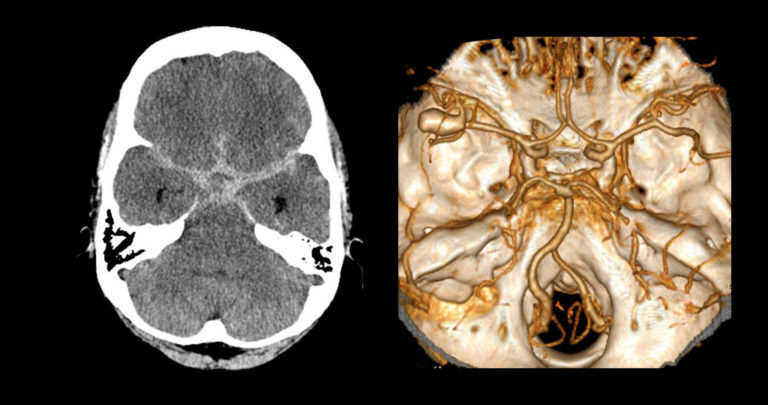 Subarachnoidalblutungen mit Bluthochdruck und Rauchen assoziiert