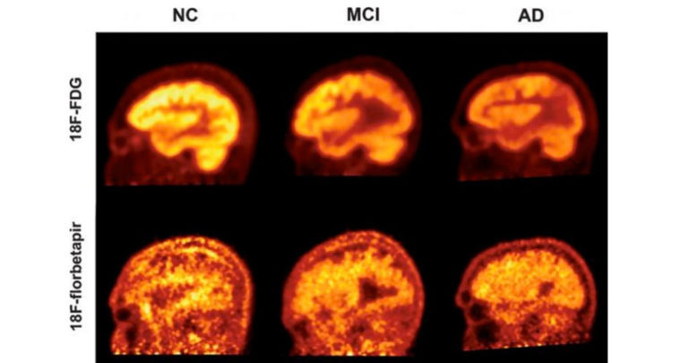 FDG-PET erkennt Alzheimer präziser als der Amyloid-PET