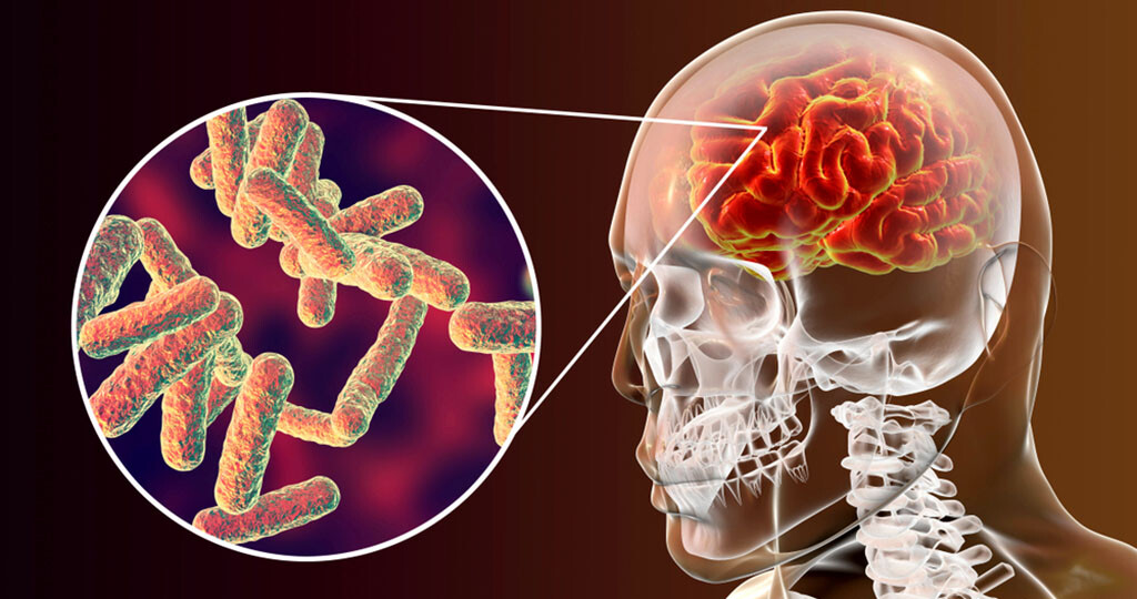 Meningitis-Kateryna Kon-shutterstock - MedMix