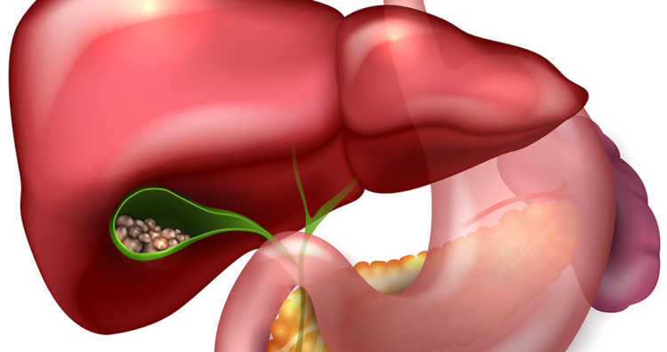 Gallensteine natürlich behandeln und Gallenfluss fördern